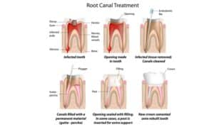 Understanding the Causes of Biting Pain After a Root Canal