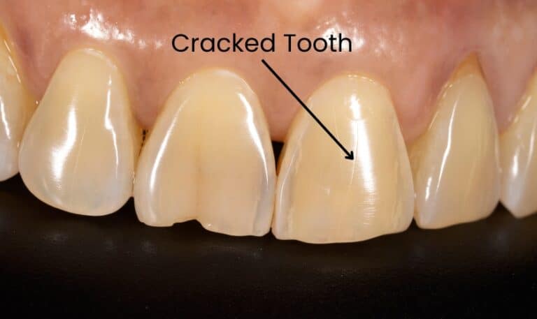 Is a Cracked Tooth an Emergency? | Urgent Dental Care Tips