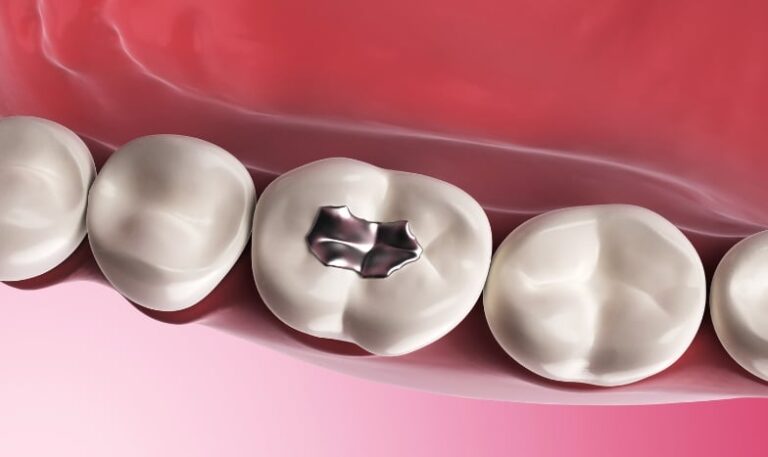 10 Effective Tips to Relieve Pain After Dental Fillings